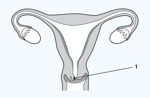 Clinical Services Information - Surgical abortion | MSI Australia